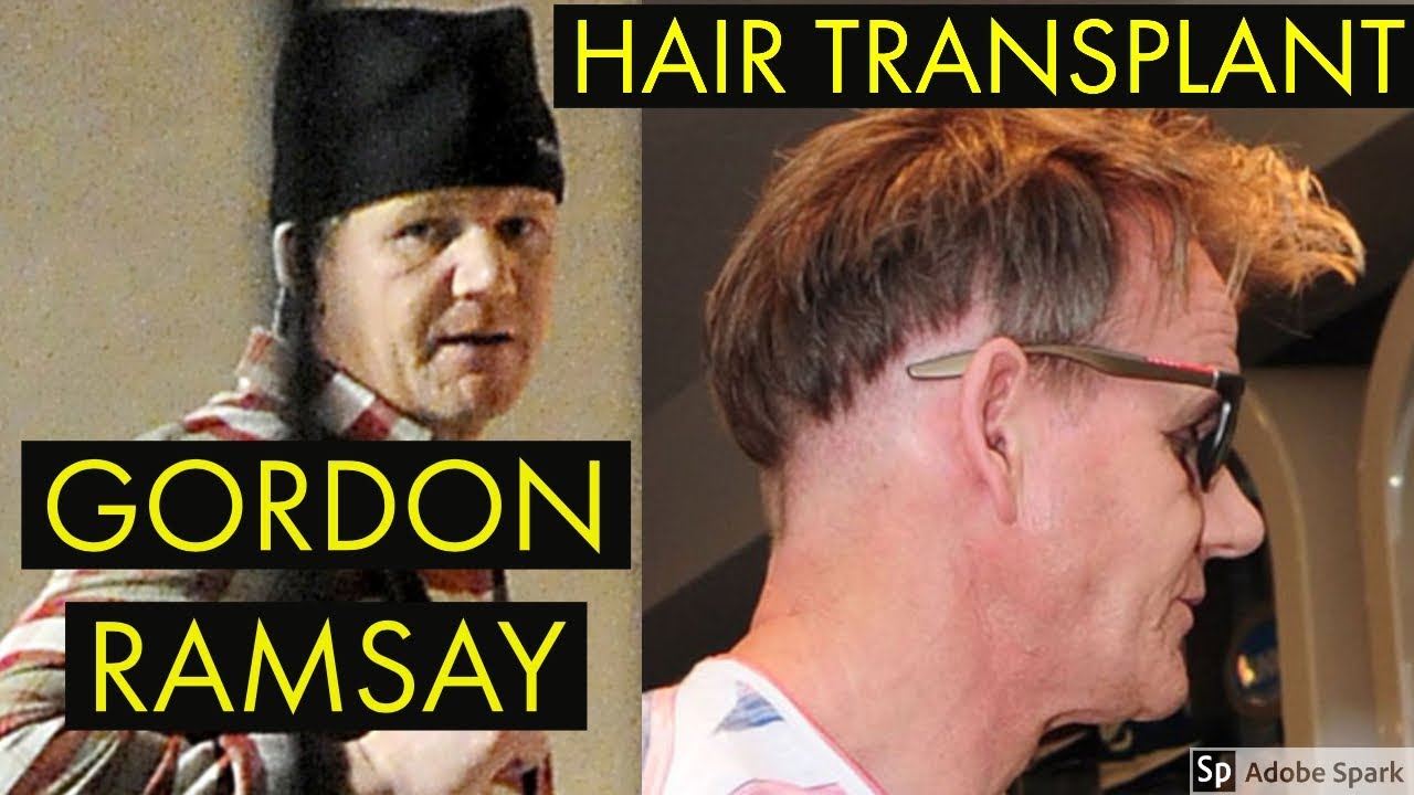 Gordon Ramsay Hair Loss