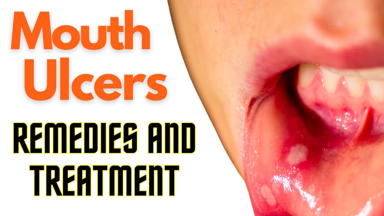 The Ultimate Guide to Healing Mouth Ulcers - YouTube