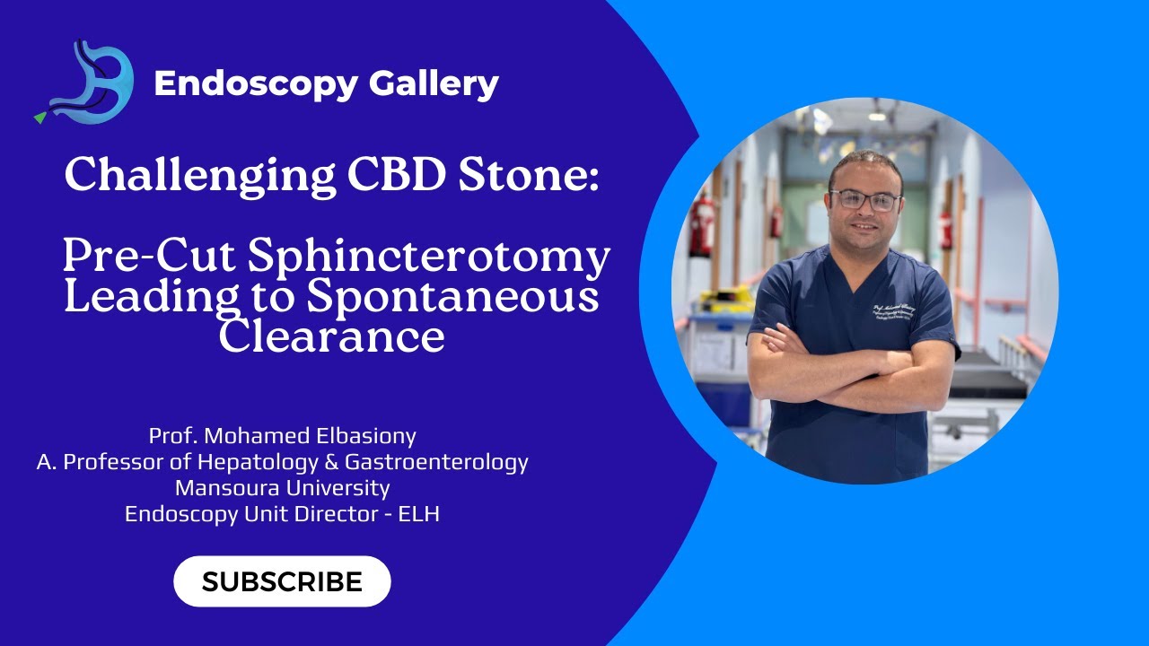 Challenging CBD Stone: Pre-Cut Sphincterotomy Leading to Spontaneous ...