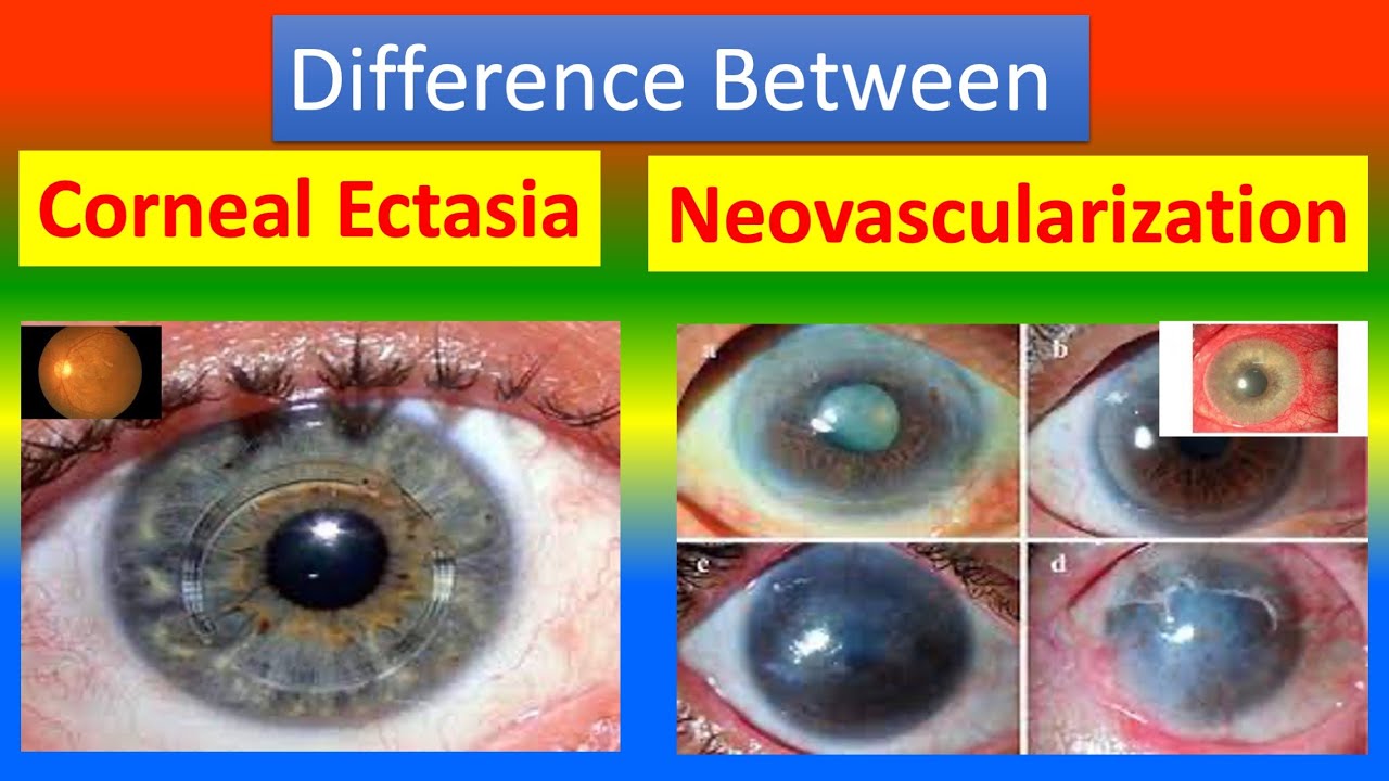 Difference Between Corneal Ectasia and Neovascularization - YouTube
