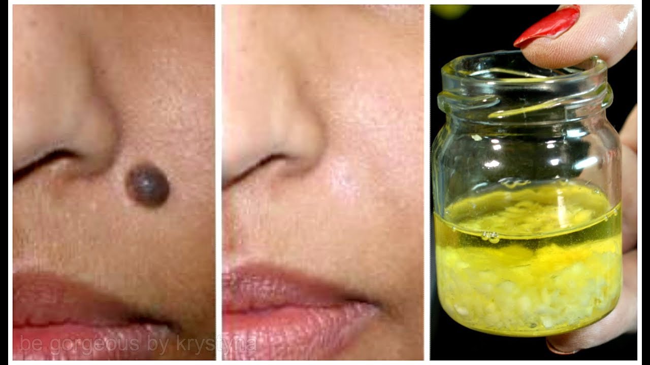 This Remedy Removes The Skin Tag In Just 7 Days | Home Remedies To ...