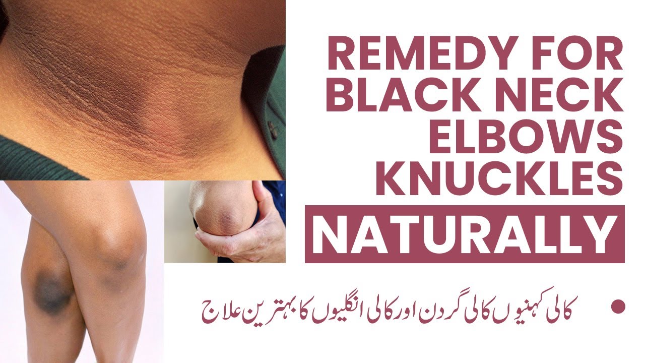 Remedy for Black Neck, Elbows, Knuckles | کالی کہنیوں،گردن،انگلیوں کا ...