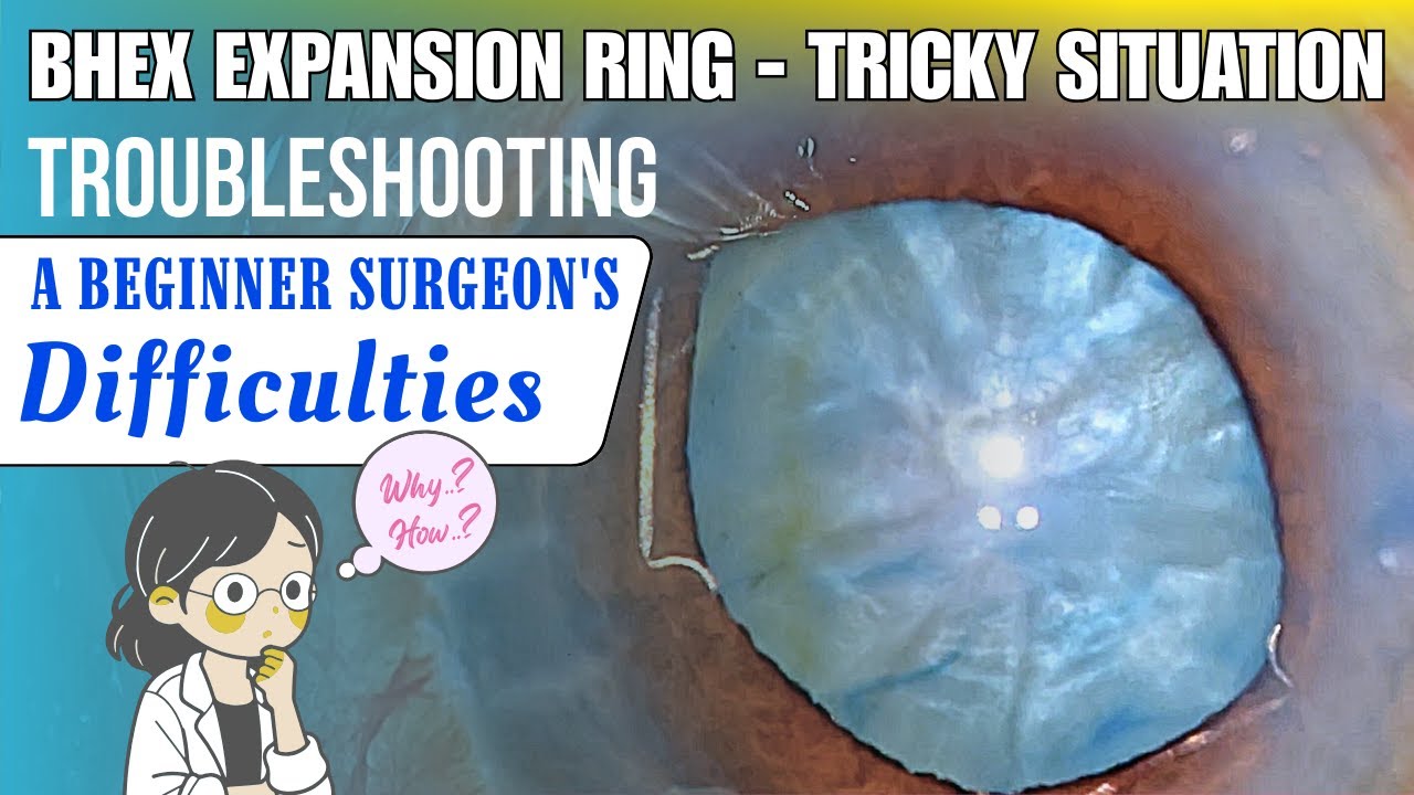 A beginner surgeon's difficulties - B-HEX Pupil Expansion Ring - Tricky ...