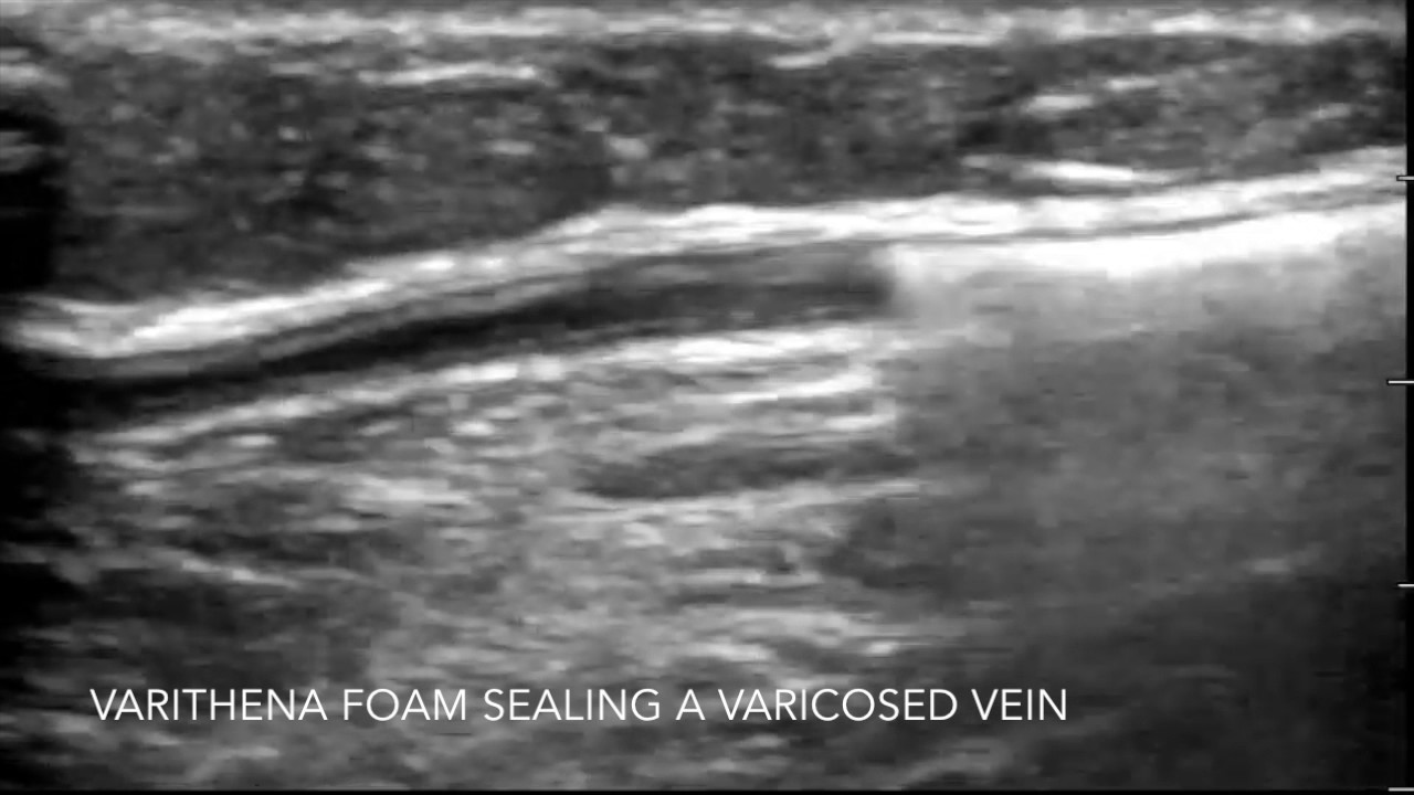 Ultrasound of Varithena Foam Sealing a Varicose Vein - YouTube