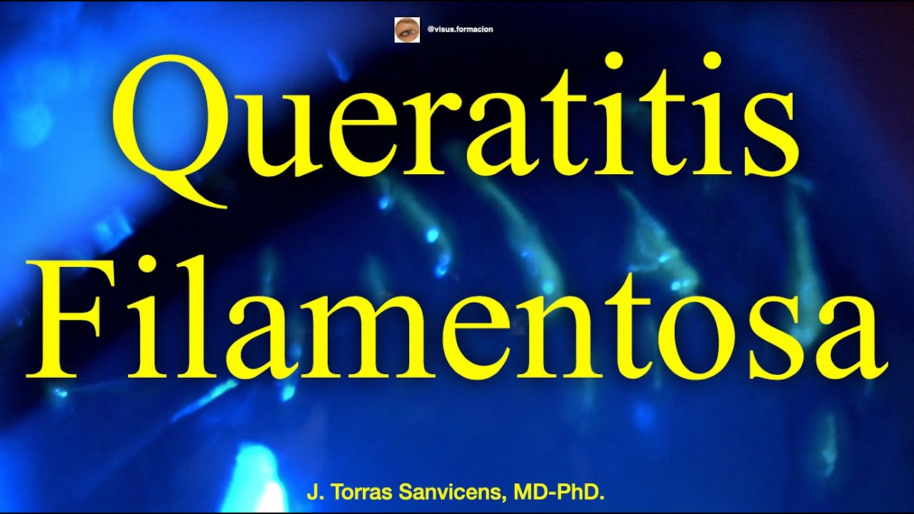 Queratitis Filamentosa. Síndrome de Ojo Seco. - YouTube