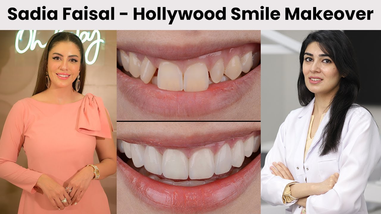 Pakistani Celebrity Sadia Faisal | Hollywood Smile Makeover | Tooth ...
