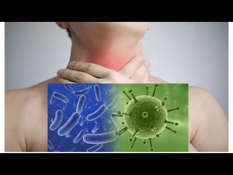 Faringitis Bacteriana VS Viral: Sintomas, Diagnostico/criterios de ...
