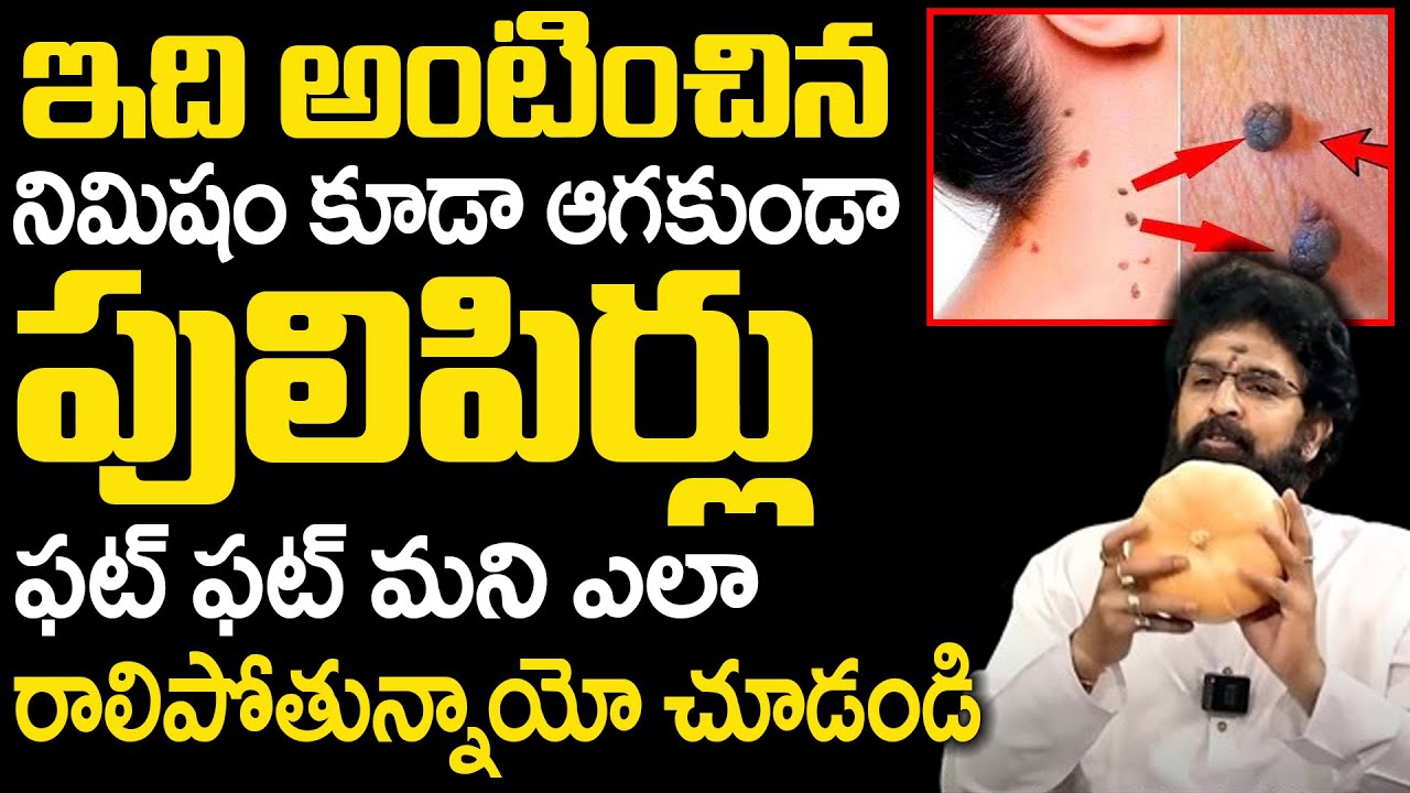 ఇది అంటించగానే నొప్పిలేకుండా పులిపిర్లు మాయం.. | vikram aditya ...