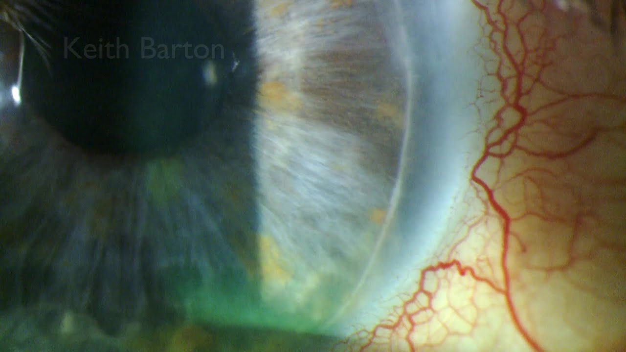 Axenfeld-Rieger Syndrome - YouTube