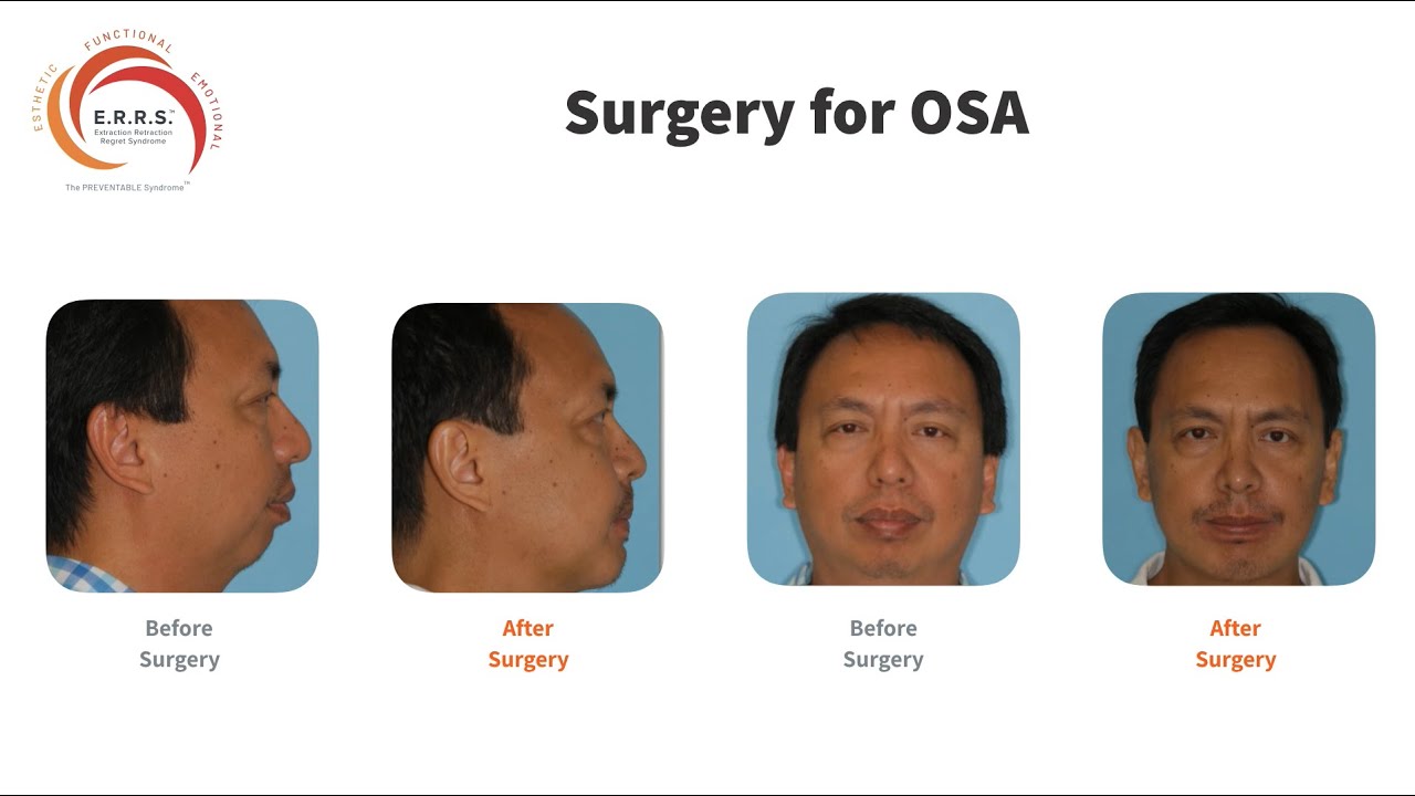 Surgery for OSA - YouTube