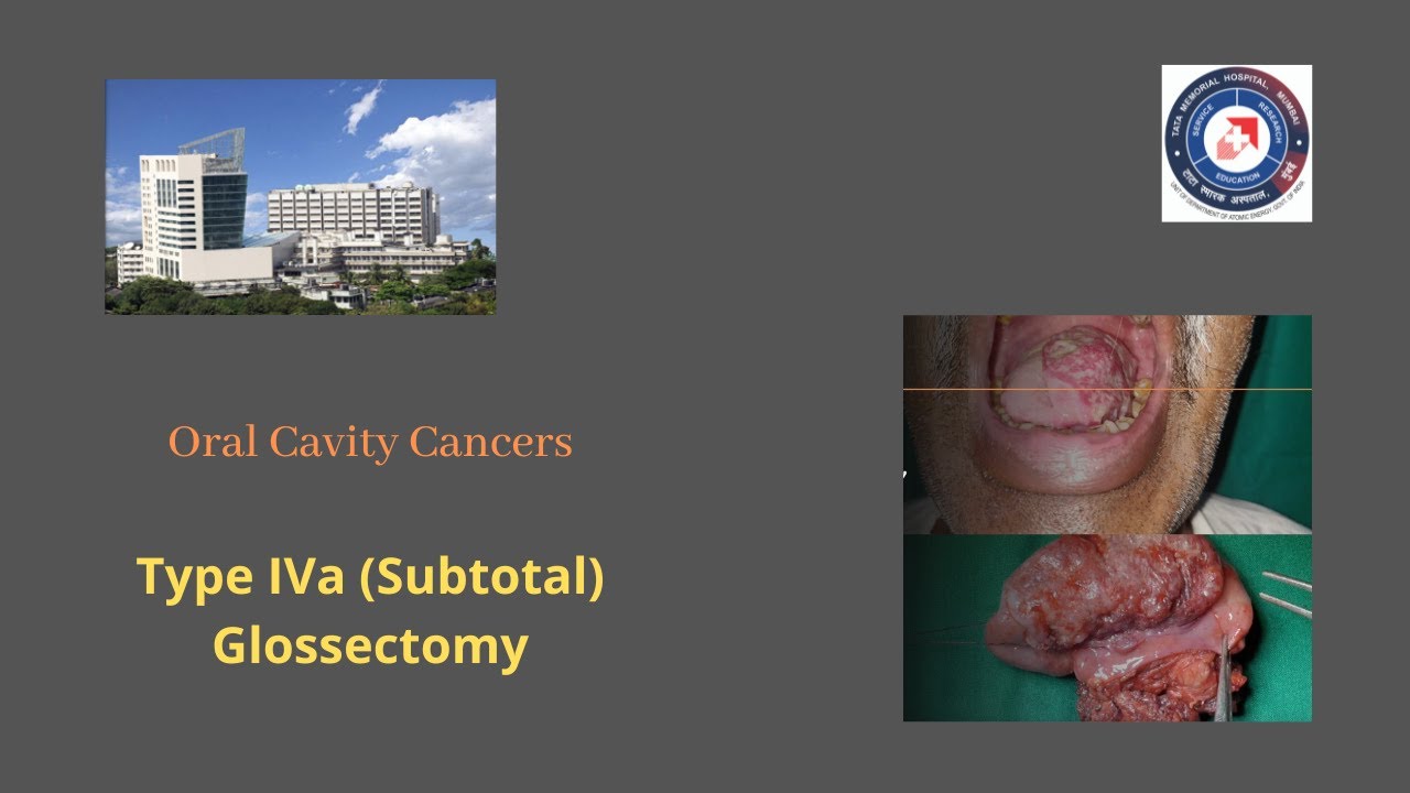 Subtotal Glossectomy, Type IVa glossectomy, Pull-Through Approach, Dr ...