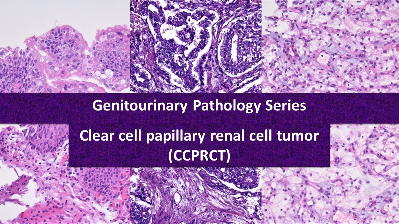 Clear cell papillary renal cell tumor (CCPRCT) 101 - high-yield ...
