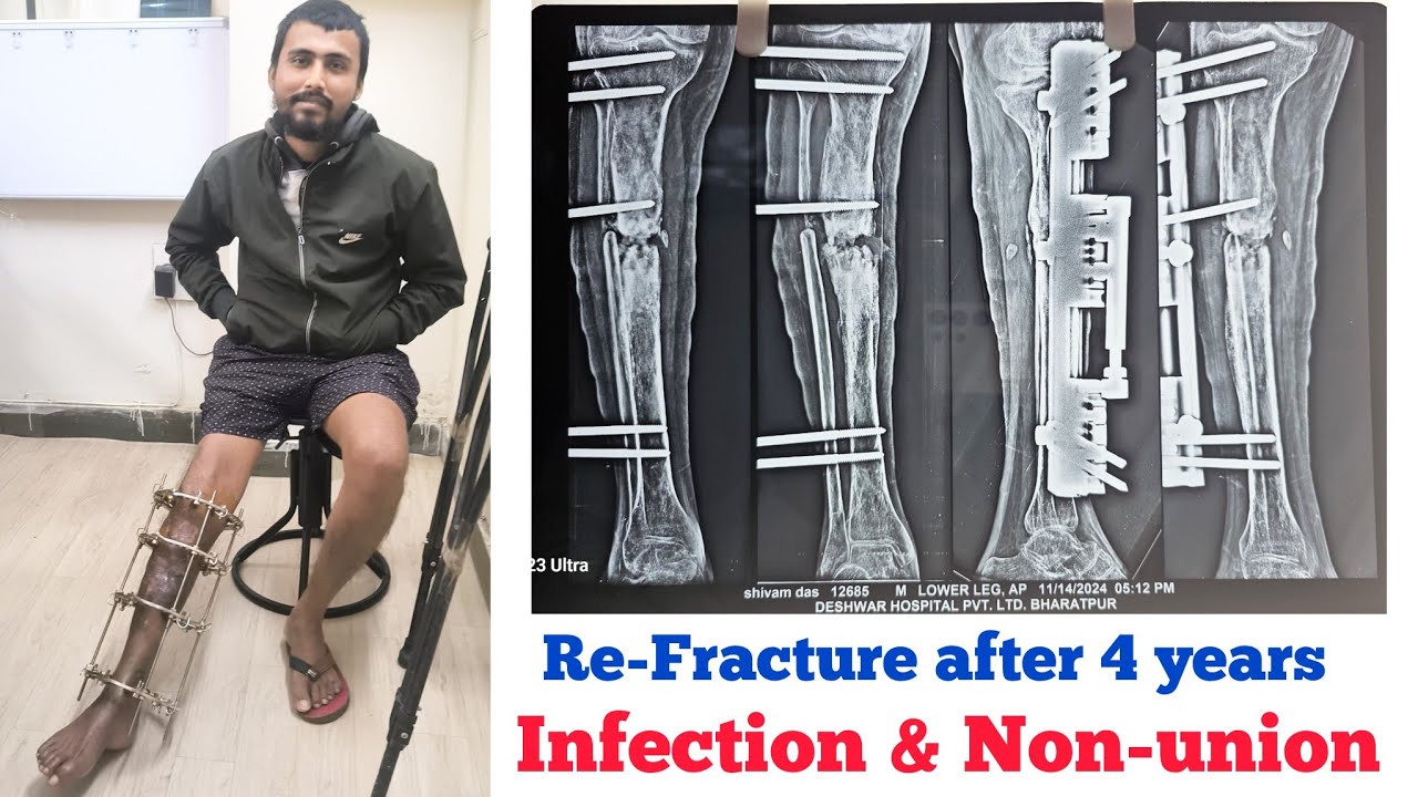 4 साल बाद हड्डी फिर से टूट गयी Re-Fracture after 4 years in tibia ...