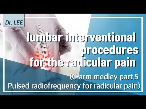 The technique of pulsed radiofrequency treatment for lumbar radicular ...