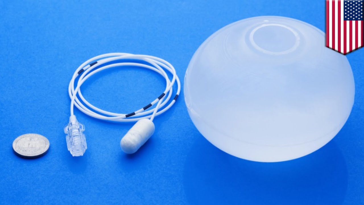 Balon lambung menurunkan berat badan tanpa operasi - Tomonews - YouTube