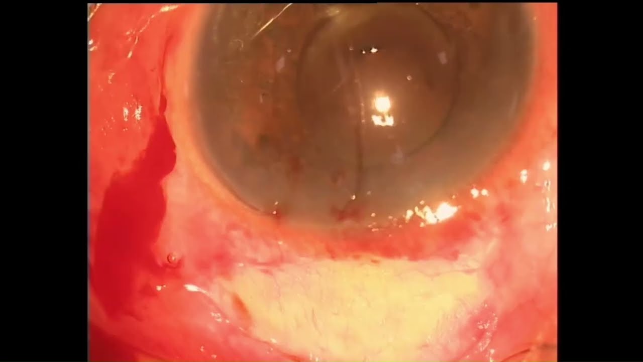 AHMED GLAUCOMA VALVE IMPLANTATION- DR VIJAYA ALLE - NEOVASCULAR ...