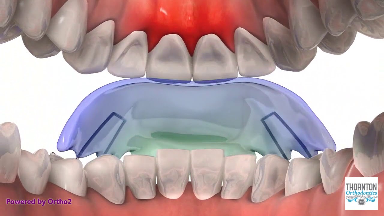 Bite Plate Open Bite - YouTube