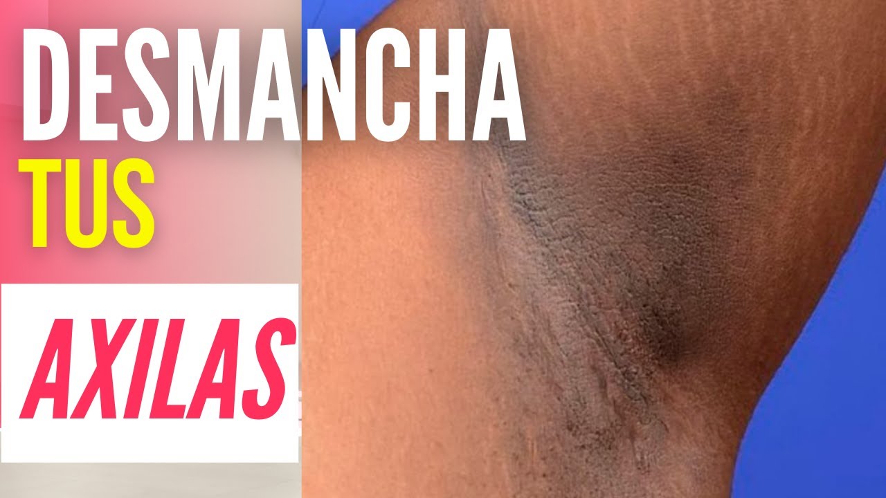 Cómo Aclarar las Axilas y la entrepierna Naturalmente/Quitar el color ...