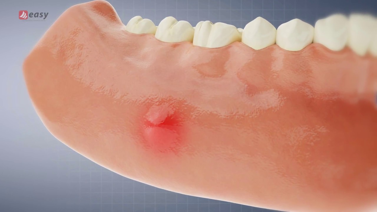 Uso das limas Prodesign Logic RT - YouTube