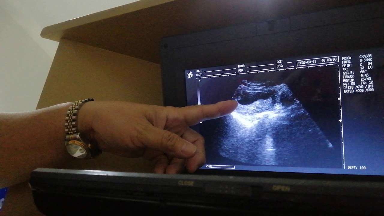 10 weeks and 1day ultrasound -very active baby movements - YouTube