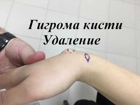 Удаление гигромы кисти
