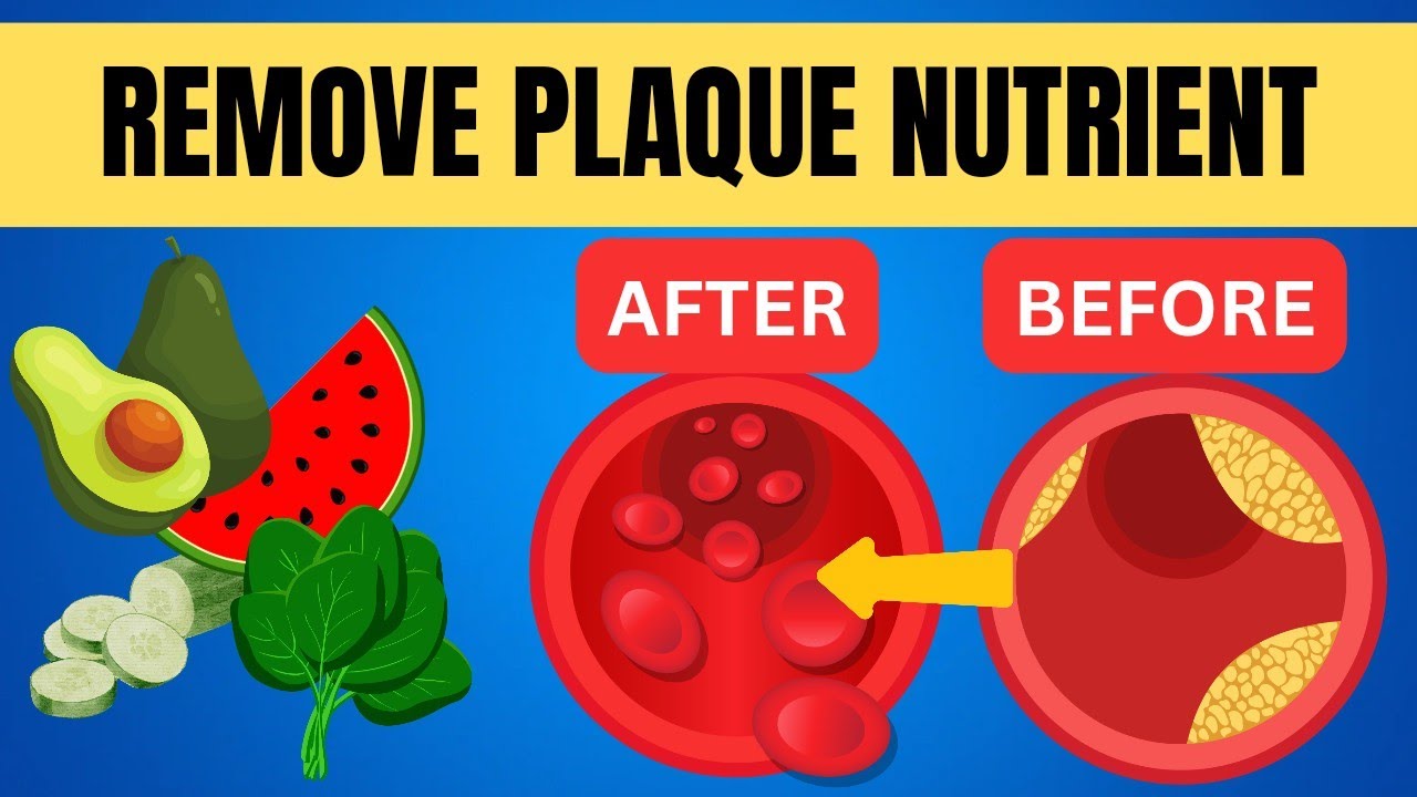 Seven Nutrients To Help Clear Your Arteries of Plaque. - YouTube