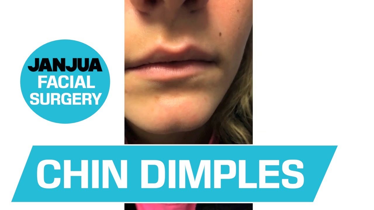 CHIN DIMPLES - 59 PLUS 1 - DR. TANVEER JANJUA - YouTube