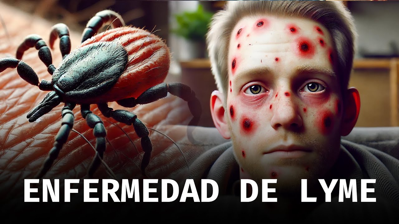 Enfermedad de Lyme: Síntomas, Diagnóstico y Tratamiento 🏥 - YouTube