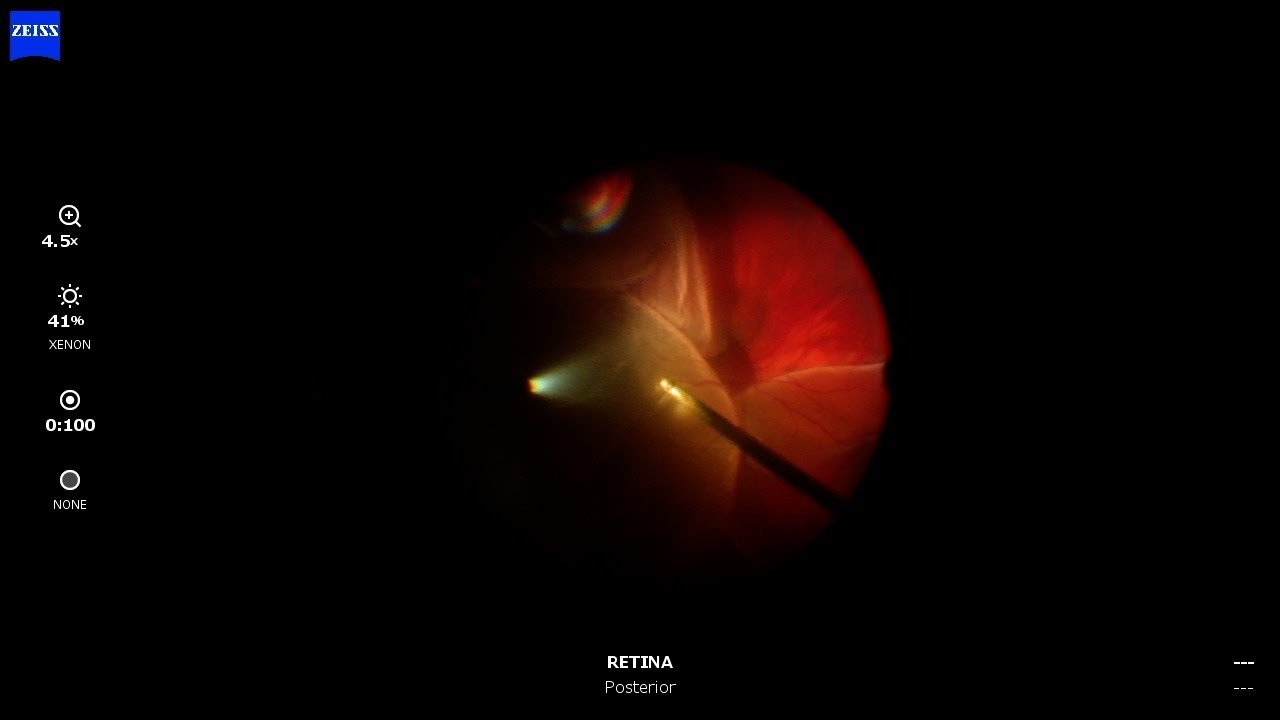 Standard 25g PPV Retinal Detachment Technique - YouTube