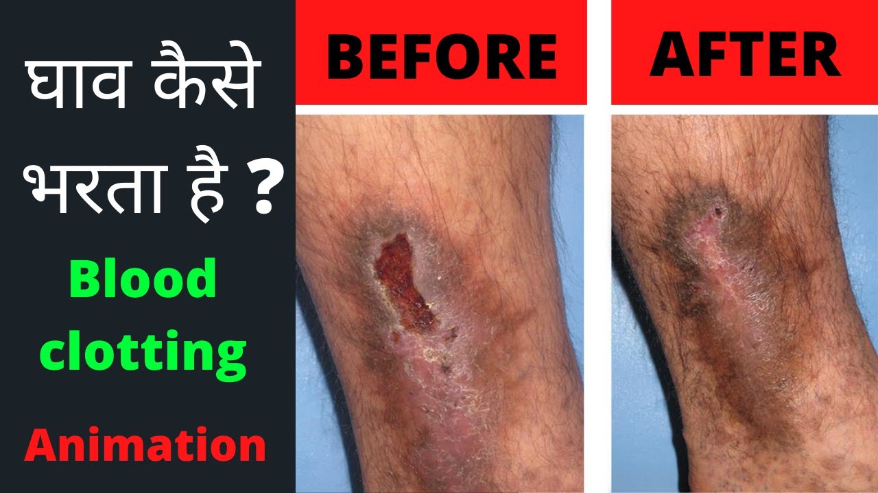 Wound healing animation | घाव कैसे भरता है ? Blood clotting ...