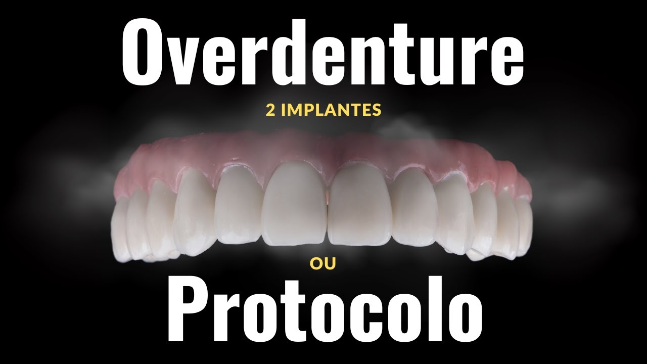 OVERDENTURE INFERIOR 2 IMPLANTES OU PROTOCOLO - QUAL É MELHOR PARA VOCÊ ...