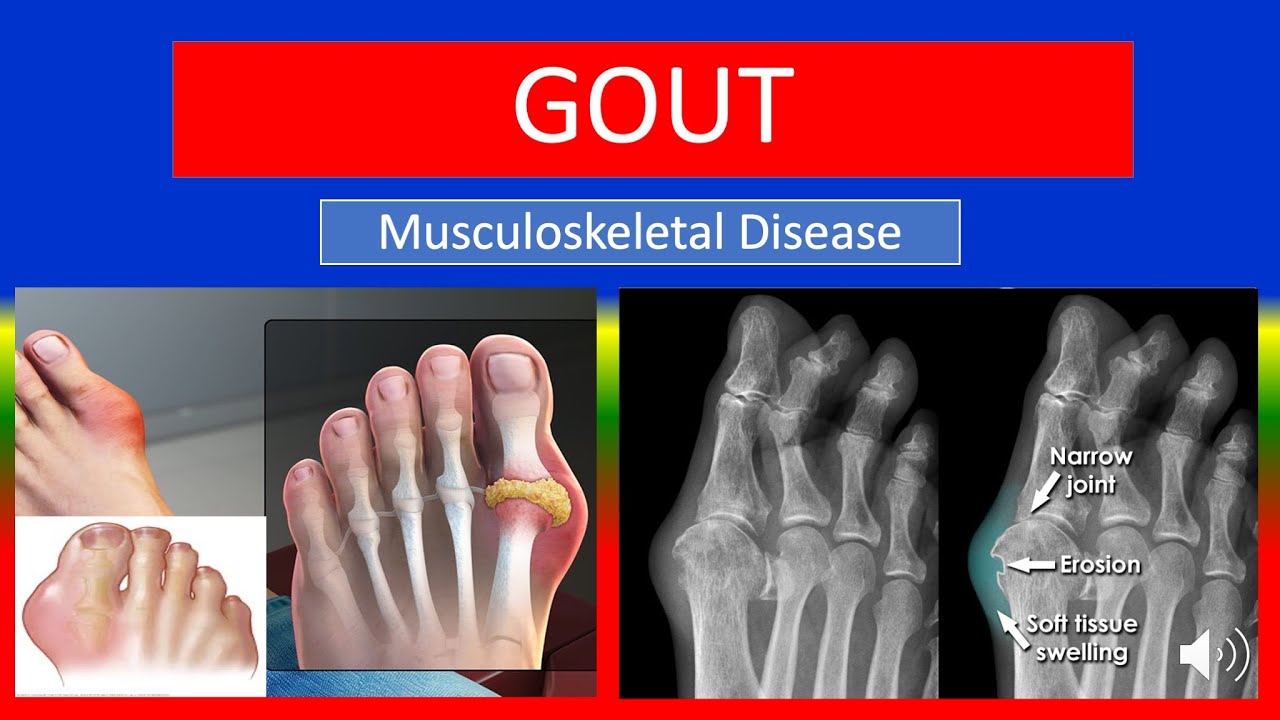GOUT - Definition, types, causes, pathophysiology, signs & symptoms ...