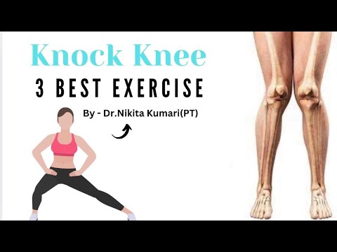 Best Exercises to correct knock knees deformity -Dr.Nikita kumari ( PT ...