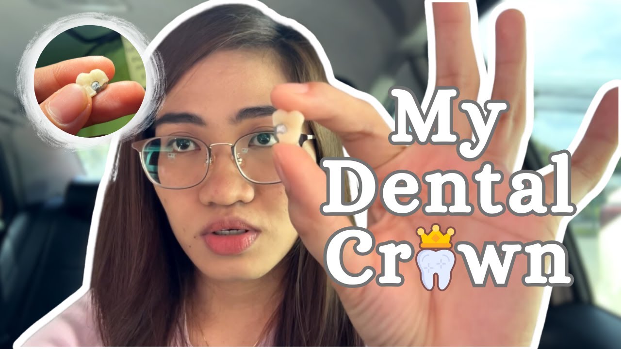 My dental crown fell off while flossing! - YouTube