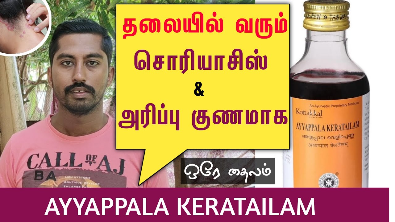 தலையில் வரும் சோரியாசிஸ் மற்றும் அரிப்பு குணமாக உதவும் தைலம் ...