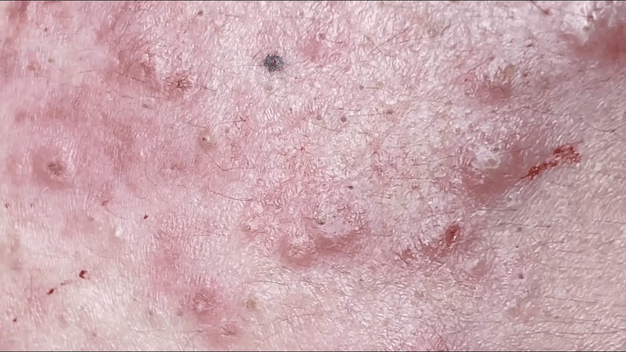 ASMR Pimple Popping - Enjoy the "Tingling" Feeling - YouTube