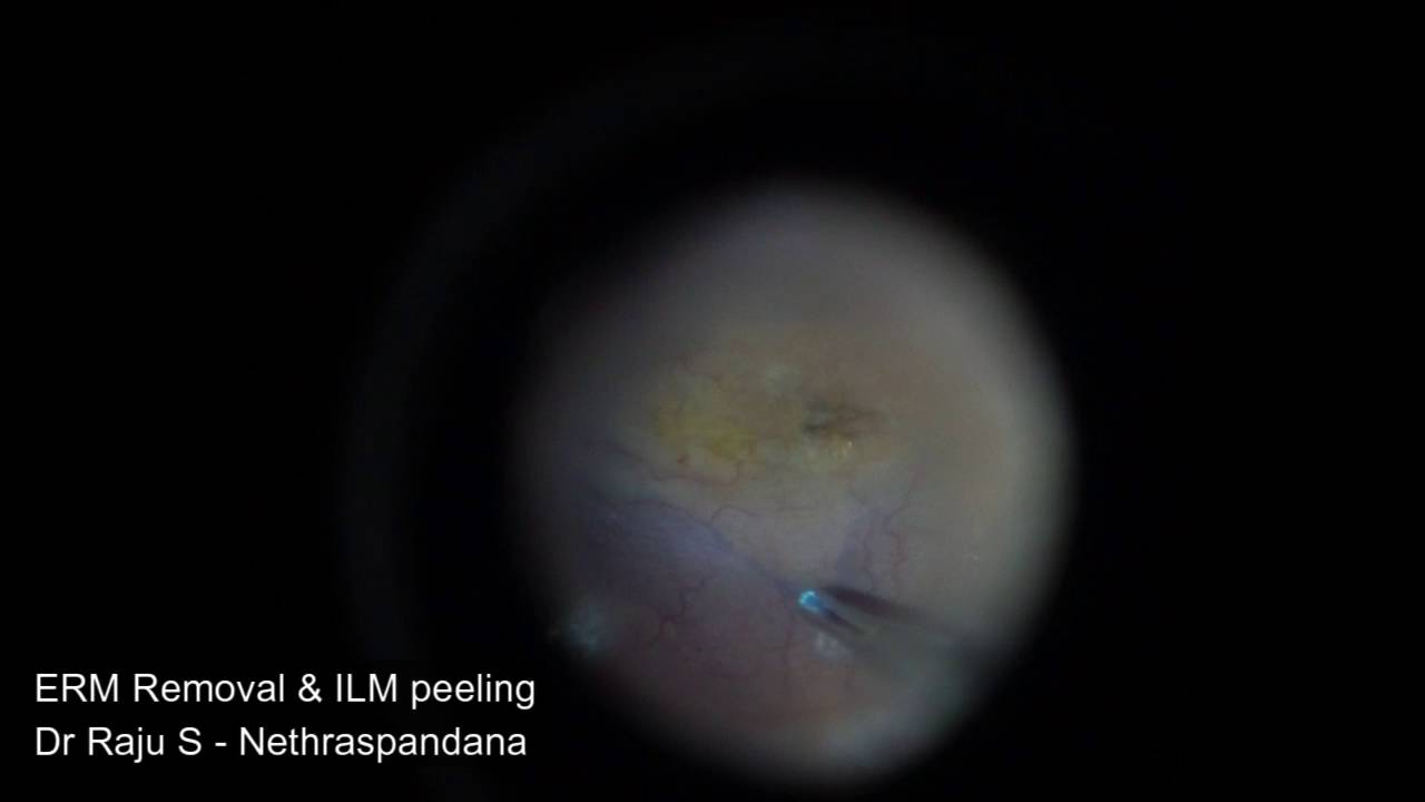 ERM and ILM peeling Dr Raju - YouTube