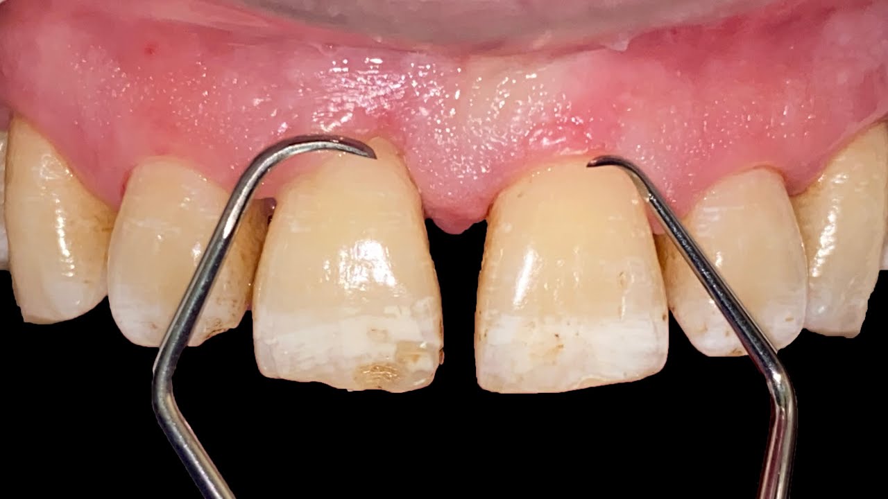 Minimally Invasive Non-Surgical Technique Vs. Traditional Subgingival ...