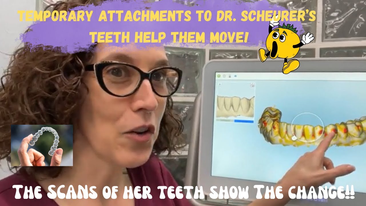 Dr. Scheurer’s Own Scans- iTero/ Invisalign Journey- Sarasota Dentist ...