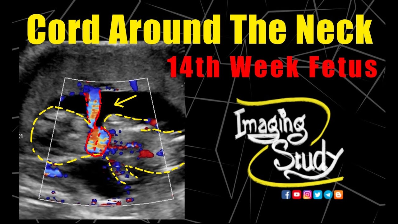 Two Layers of Cord Around The Neck of a 14th Week Fetus || Ultrasound ...