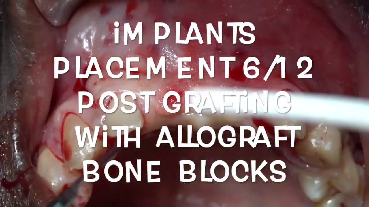 Two front implants in grafted area: following Allograft blocks From ...