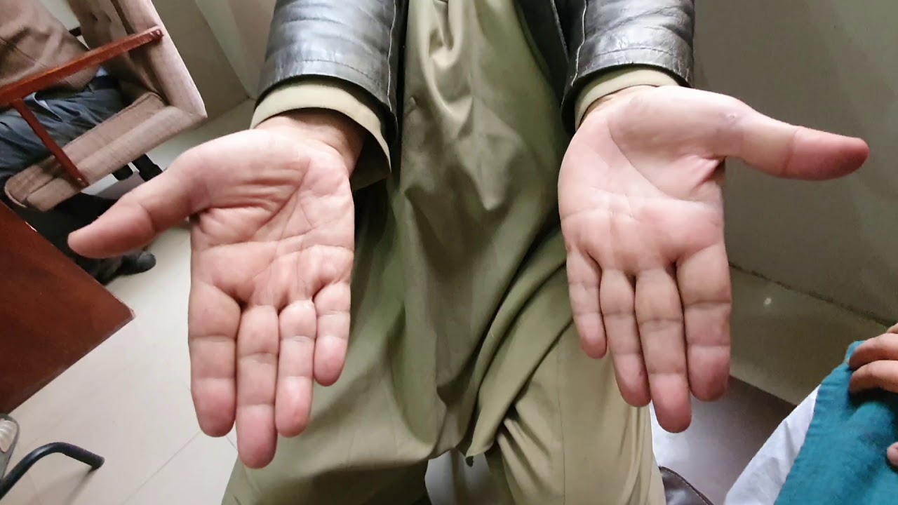 Thenar And Hypothenar Atrophy YouTube thenar-and-hypothenar-atrophy-youtube