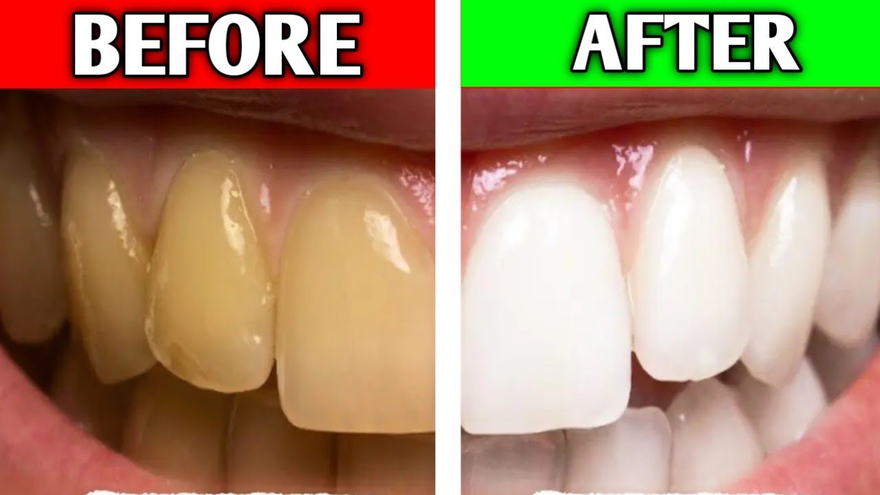 10 Easy Teeth Whitening Tips at Home for a Brighter Smile!" - YouTube