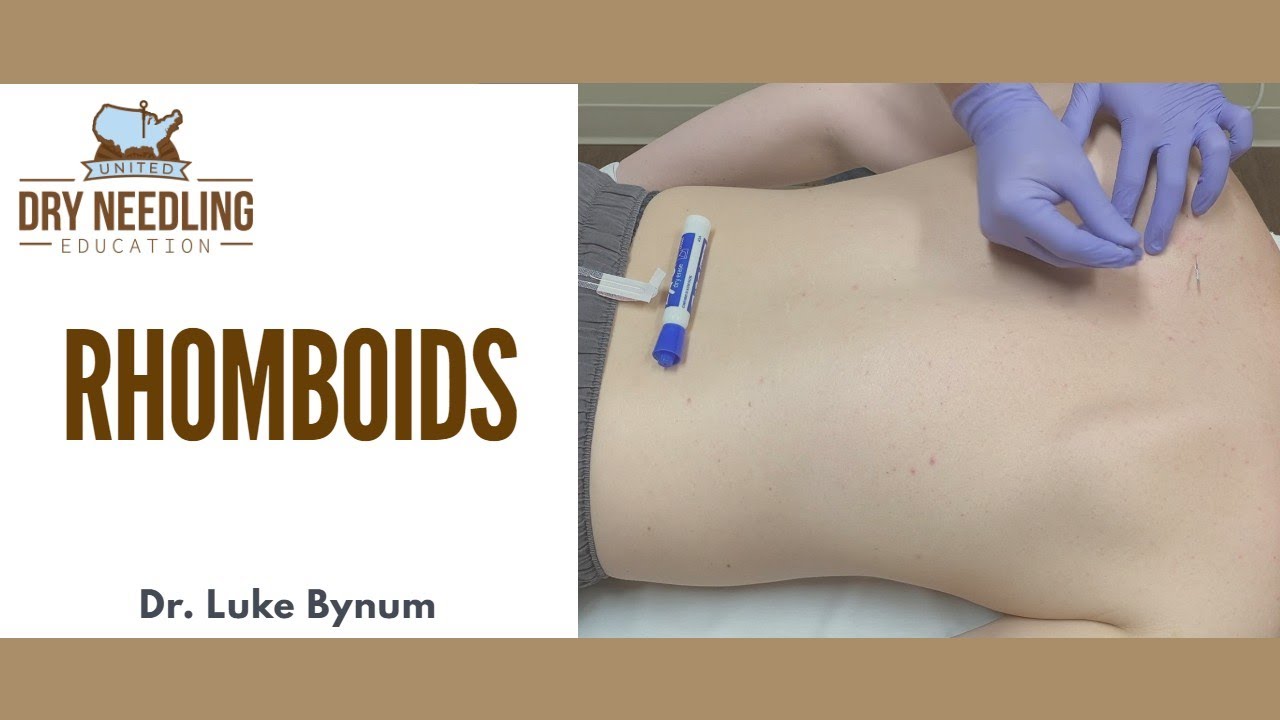 Dry Needling Rhomboids - YouTube