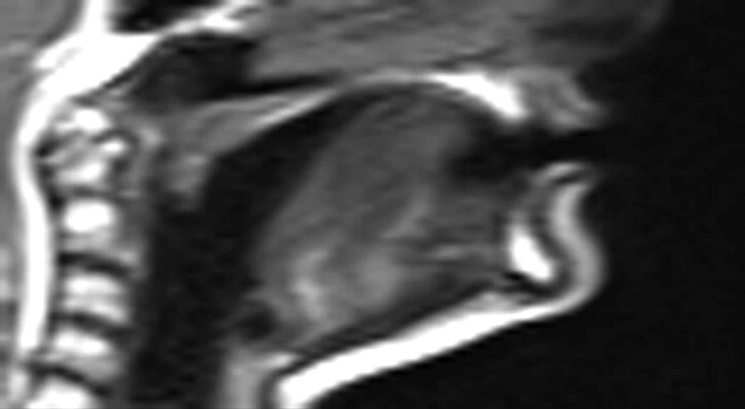 Ultrax MRI vd alveolar approximant - YouTube