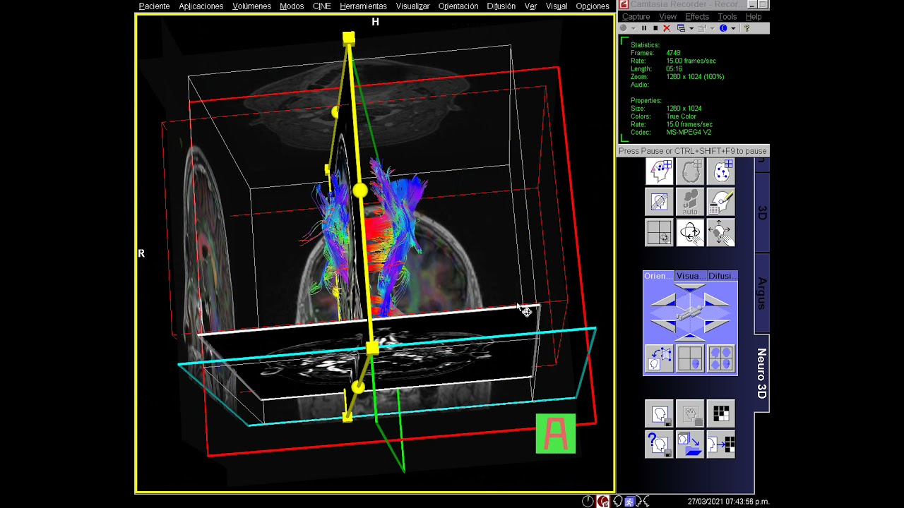 DTi #FiberTracking by #Siemens - #Tractografia - YouTube