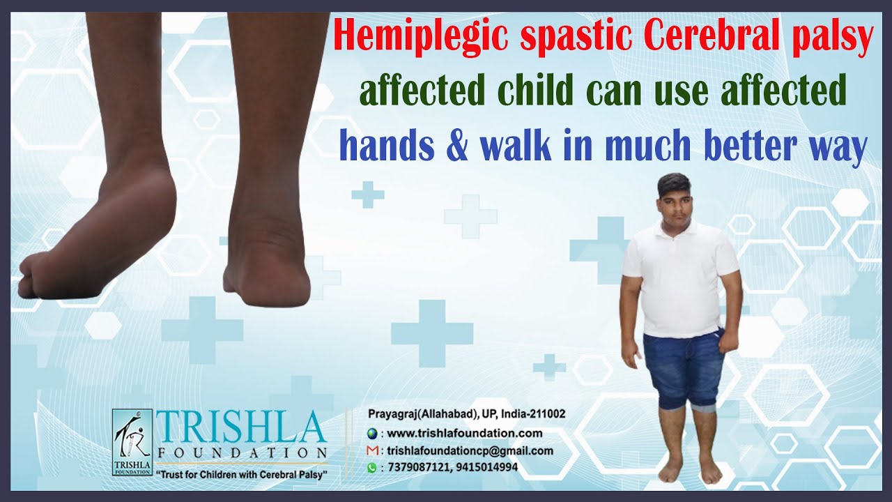 Hemiplegic spastic Cerebral palsy affected child can use affected hands ...