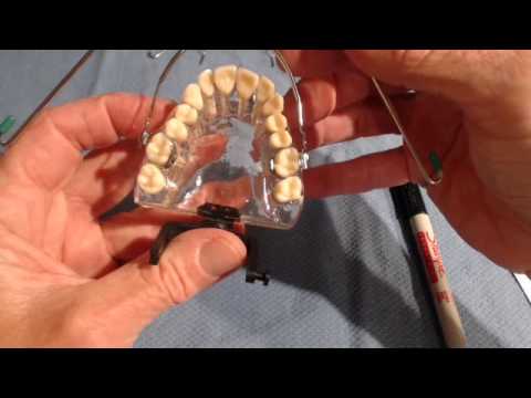 Cervical Headgear delivery, inner bow adjustment - YouTube