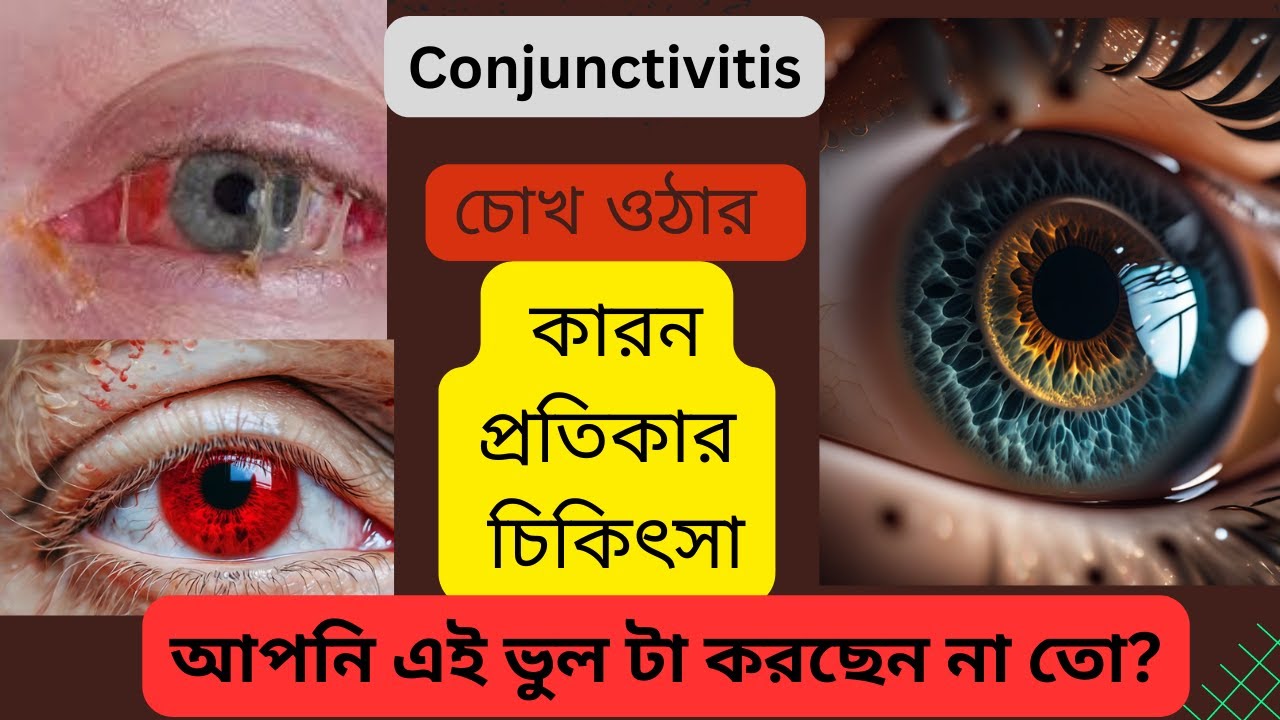চোখ ওঠার কারন,প্রতিকার, চিকিৎসা (Conjunctivitis- prevention and ...