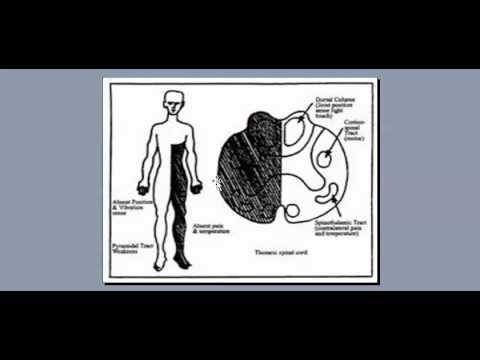 hemisection of the spinal cord - YouTube